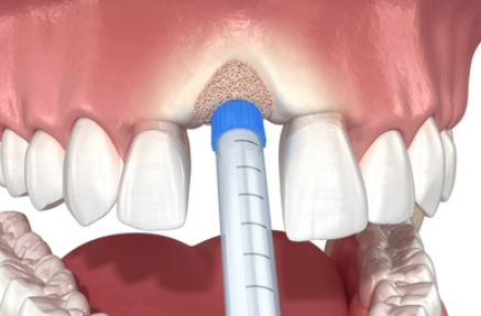 How Much Bone is Needed for a Dental Implant? Socket Preservation & Gu ...