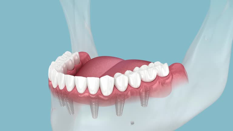 How to Achieve a Precise All-on-4 Shelf with Ridge Reduction Burs ...